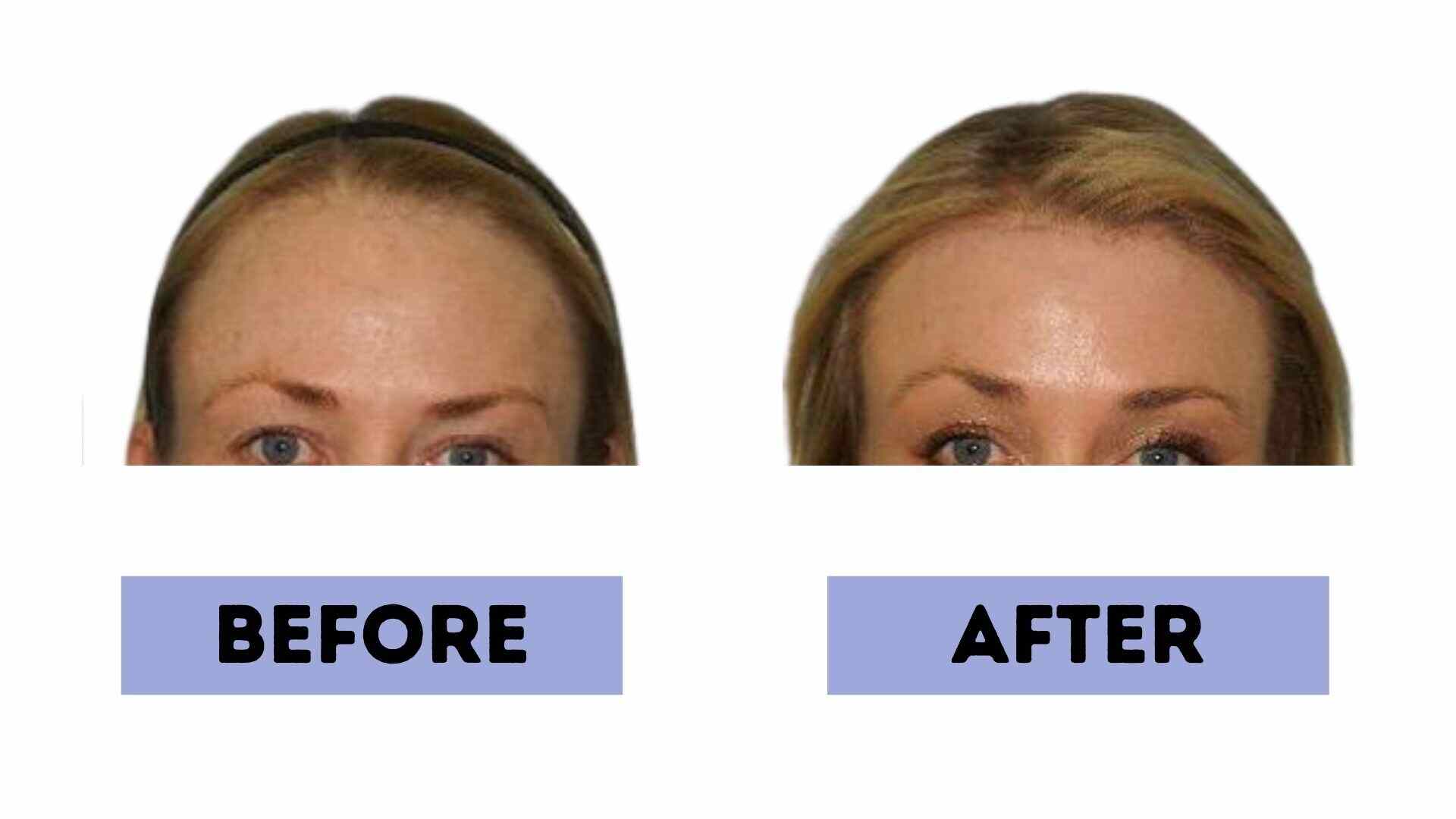 1. How To Decrease Forehead Reduction Surgery Cost?